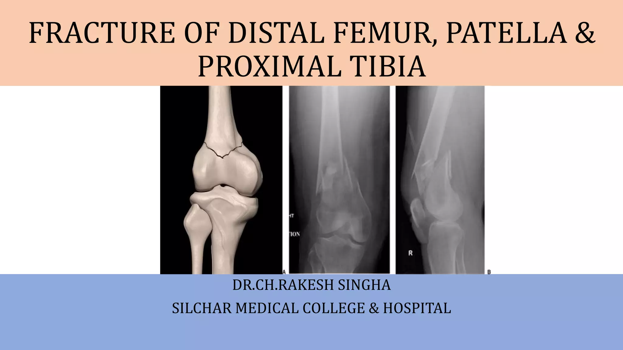DISTAL FEMUR, PATELLA, PROXIMAL TIBIA FRACTURE.pptx