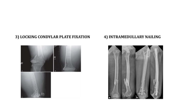 DISTAL FEMUR, PATELLA, PROXIMAL TIBIA FRACTURE.pptx