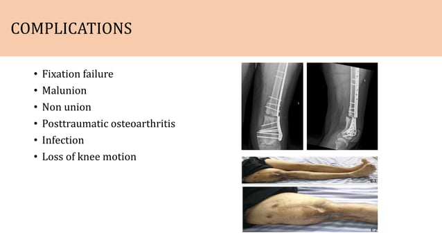 DISTAL FEMUR, PATELLA, PROXIMAL TIBIA FRACTURE.pptx