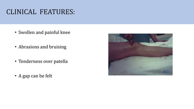 DISTAL FEMUR, PATELLA, PROXIMAL TIBIA FRACTURE.pptx