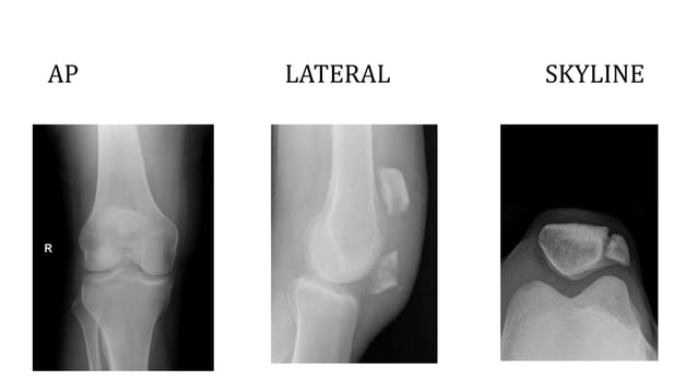 DISTAL FEMUR, PATELLA, PROXIMAL TIBIA FRACTURE.pptx