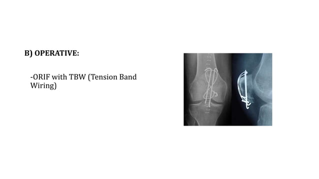 DISTAL FEMUR, PATELLA, PROXIMAL TIBIA FRACTURE.pptx
