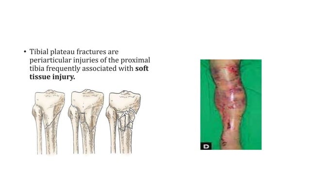 DISTAL FEMUR, PATELLA, PROXIMAL TIBIA FRACTURE.pptx