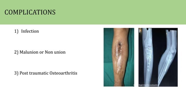 DISTAL FEMUR, PATELLA, PROXIMAL TIBIA FRACTURE.pptx