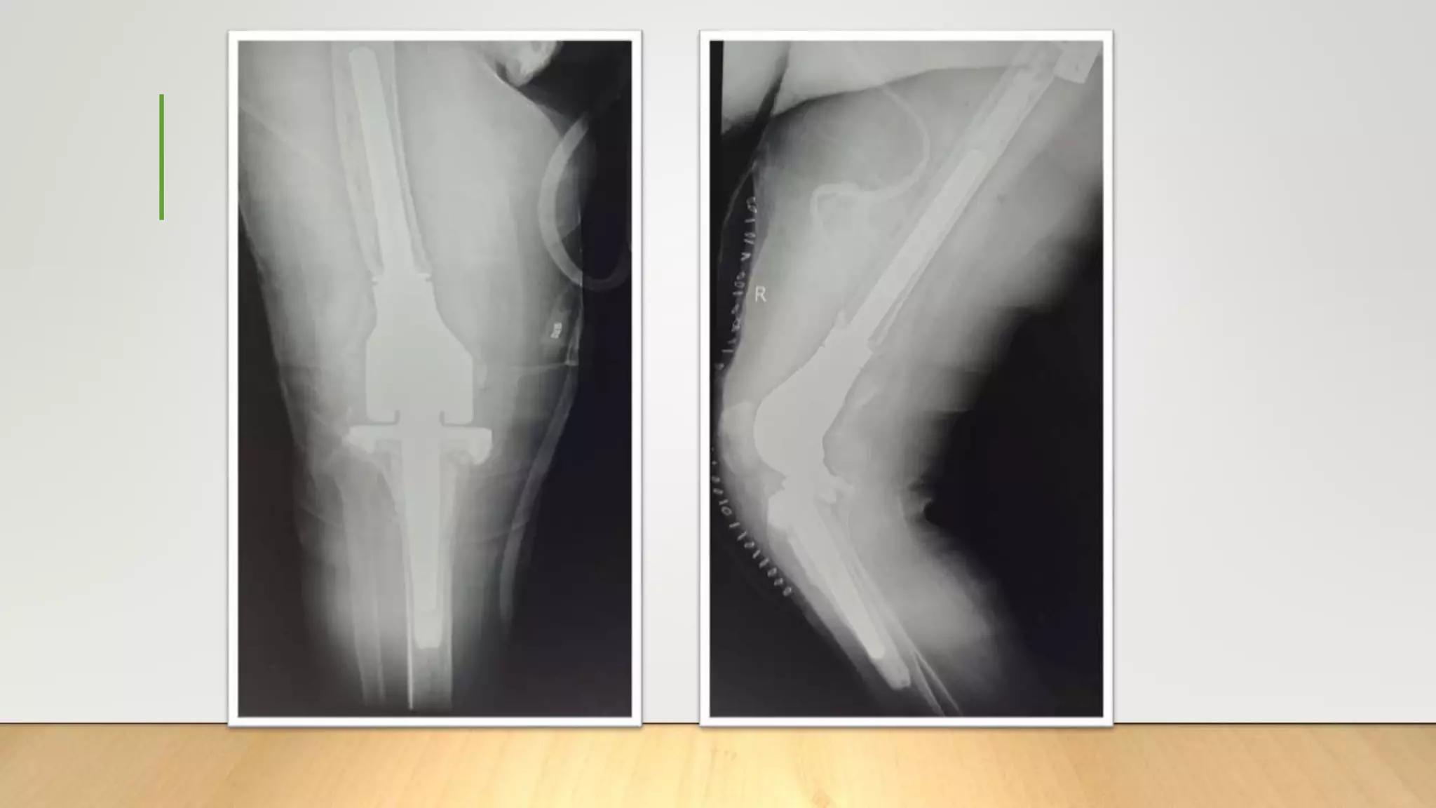 Distal Femur Periprosthetic Fracture.pptx