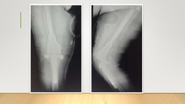 Distal Femur Periprosthetic Fracture.pptx