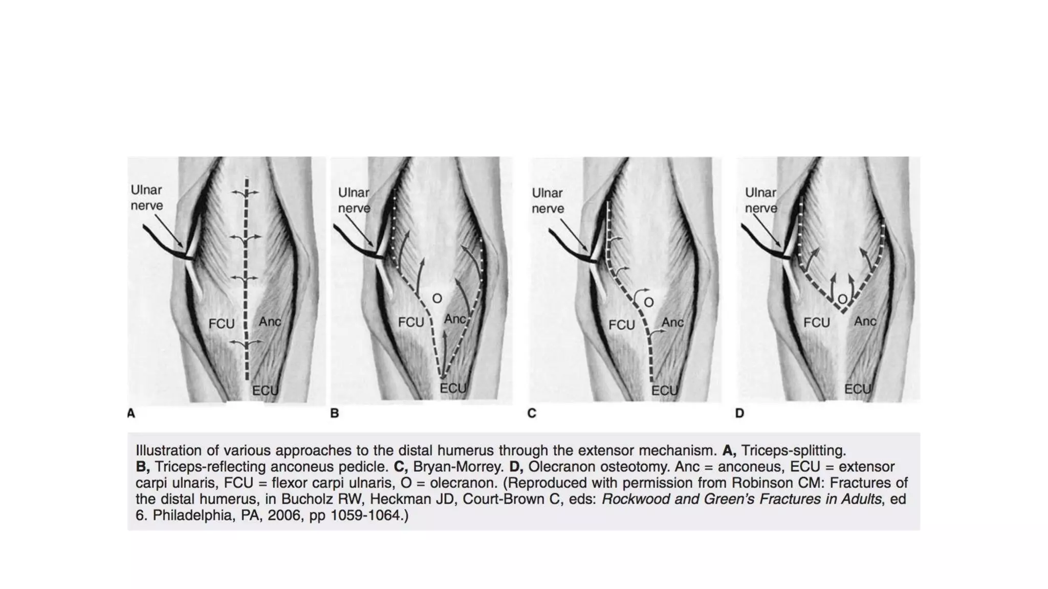 Distal humeral fracture | PPTX