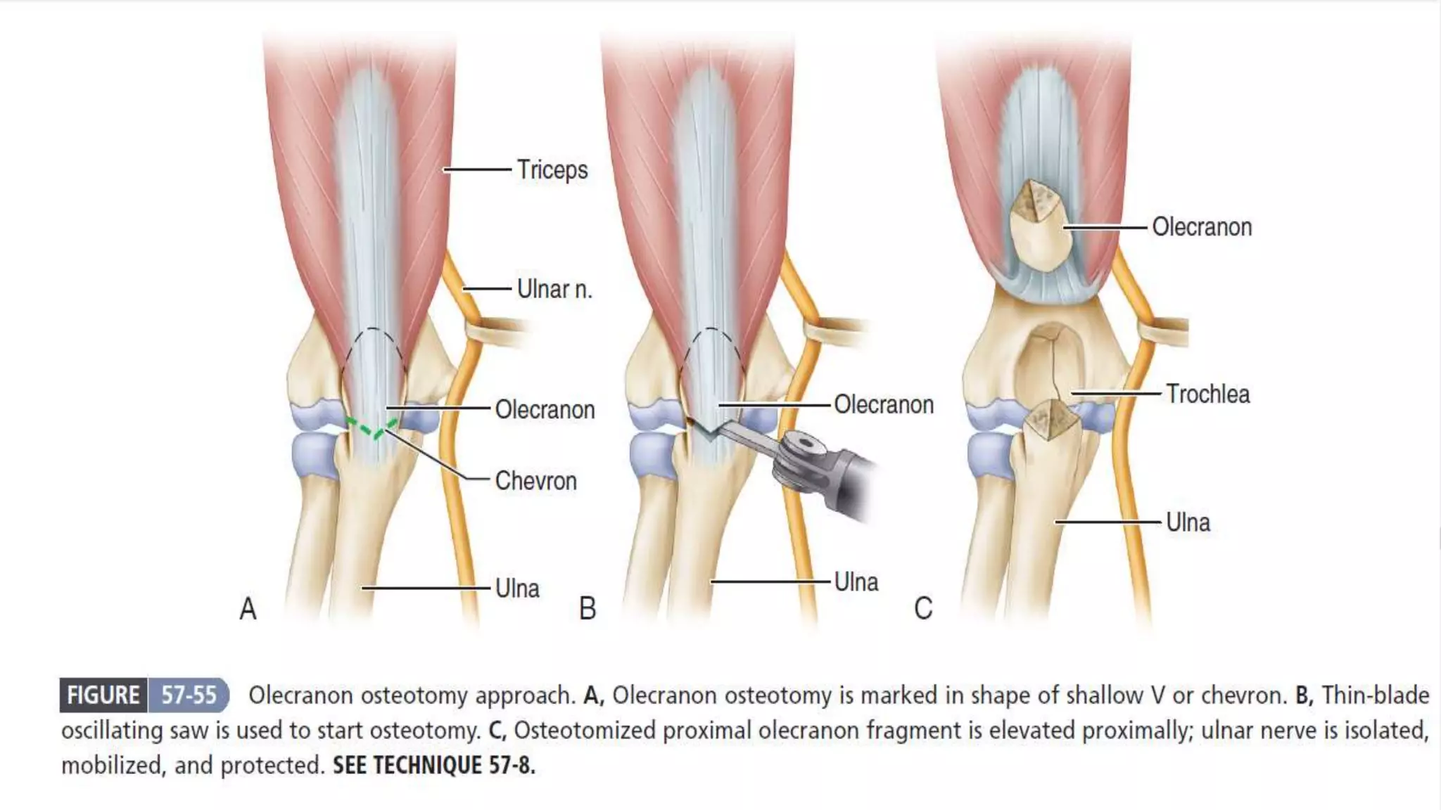Distal humeral fracture | PPTX