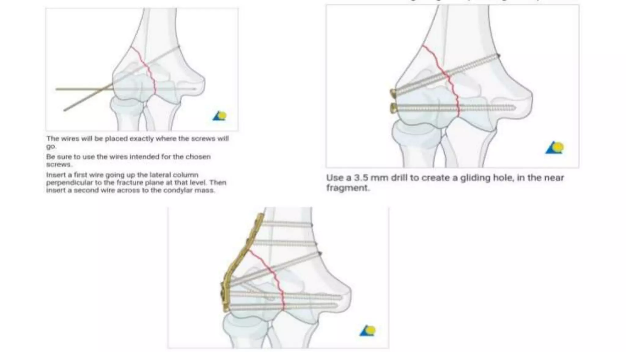 Distal humeral fracture | PPTX