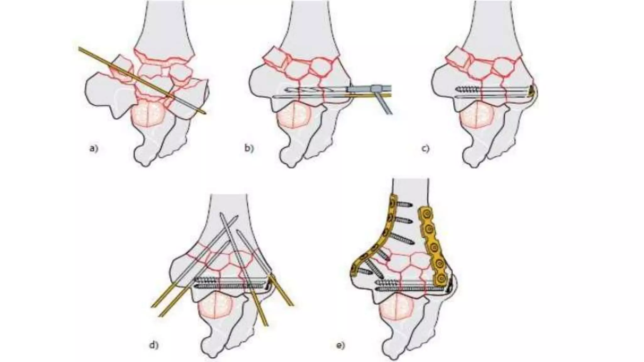 Distal humeral fracture | PPTX