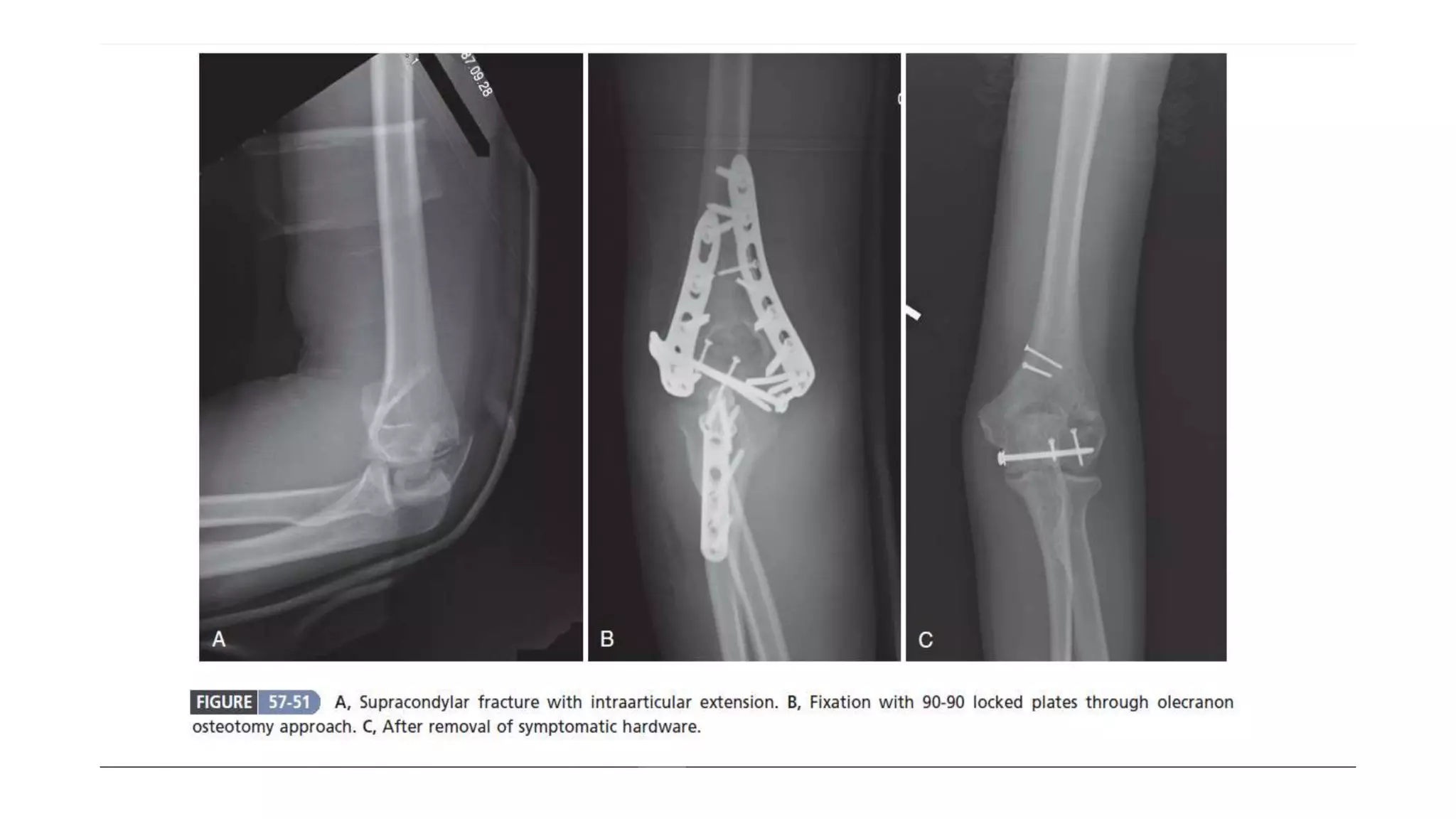 Distal humeral fracture | PPTX