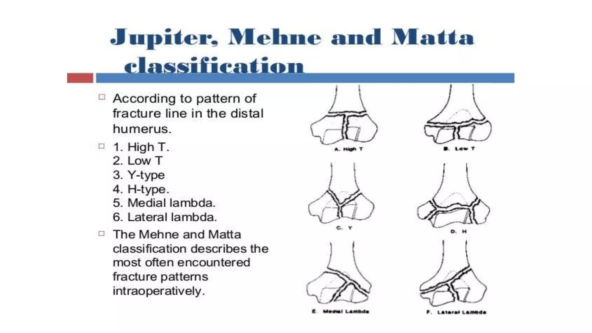 Distal humeral fracture | PPTX