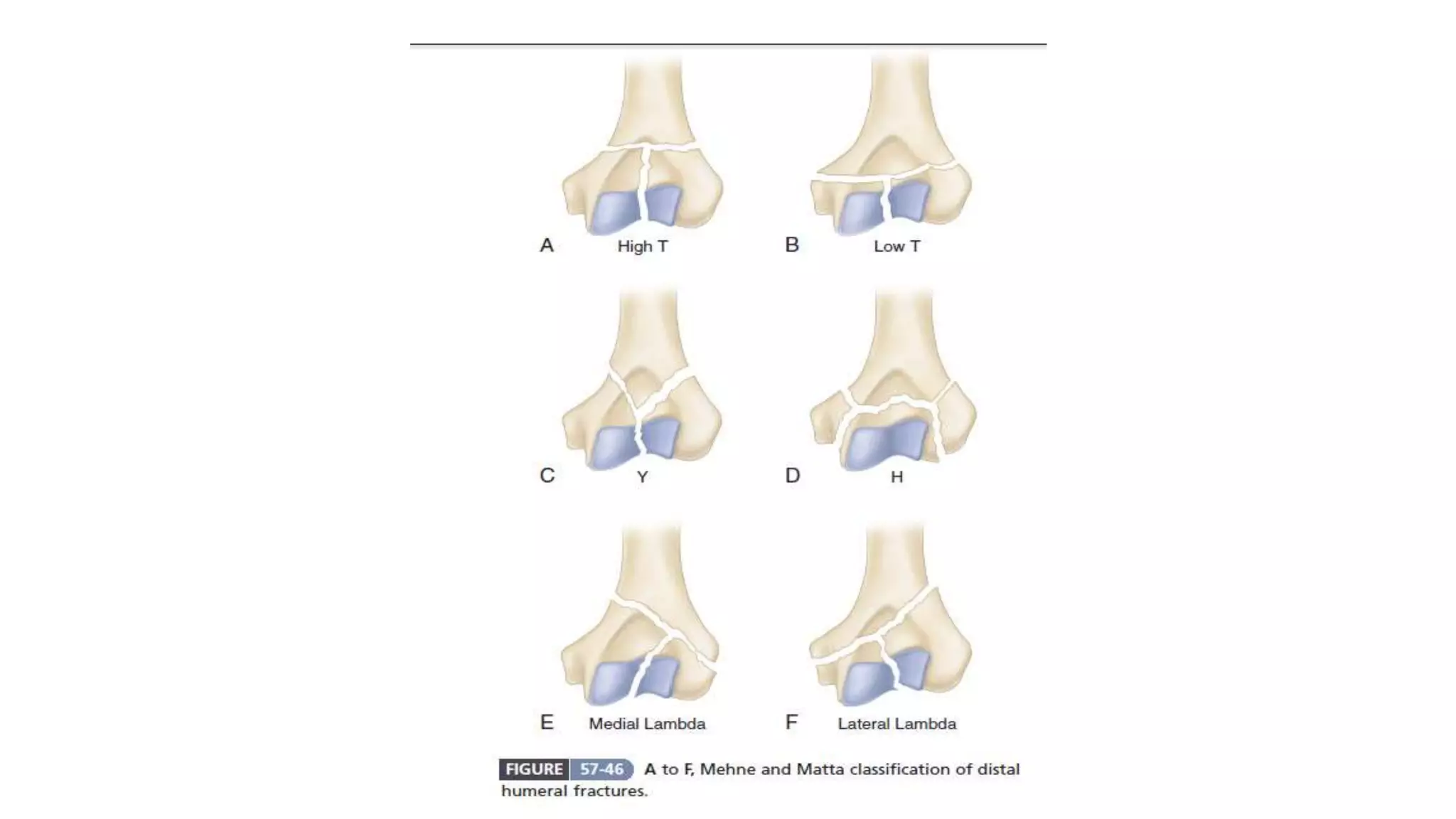 Distal humeral fracture | PPTX