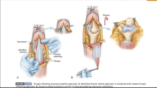 Distal humeral fracture | PPTX