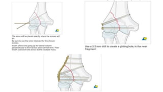 Distal humeral fracture | PPTX