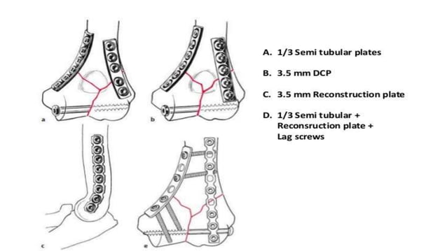 Distal humeral fracture | PPTX