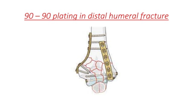 Distal humeral fracture | PPTX