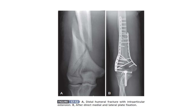 Distal humeral fracture | PPTX