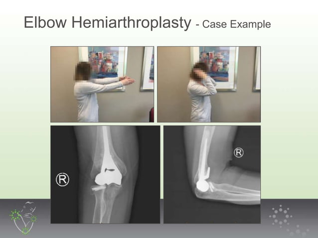 Distal Humeral Fractures – How to Fix Them, with Correlation with ...