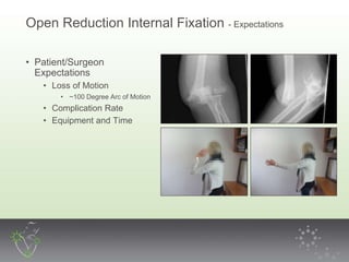 Distal Humeral Fractures – How to Fix Them, with Correlation with ...