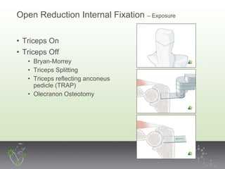 Distal Humeral Fractures – How to Fix Them, with Correlation with ...