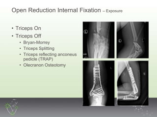 Distal Humeral Fractures – How to Fix Them, with Correlation with ...