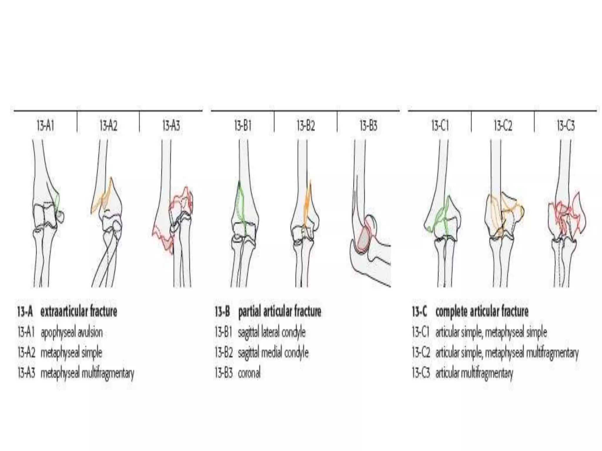 Distal humerus fracture | PPTX