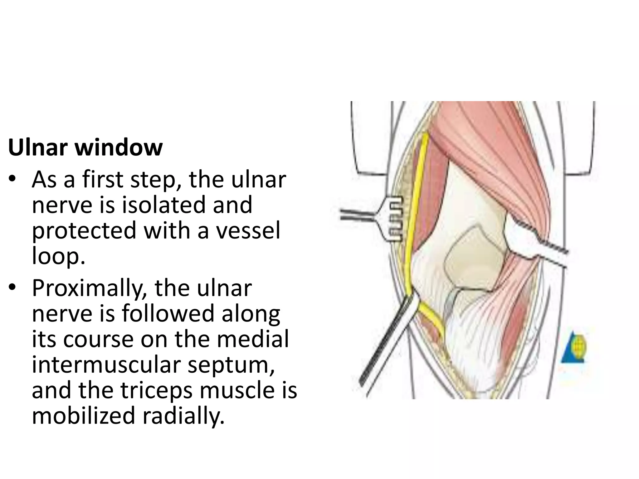 Distal Humerus Fracture Pptx