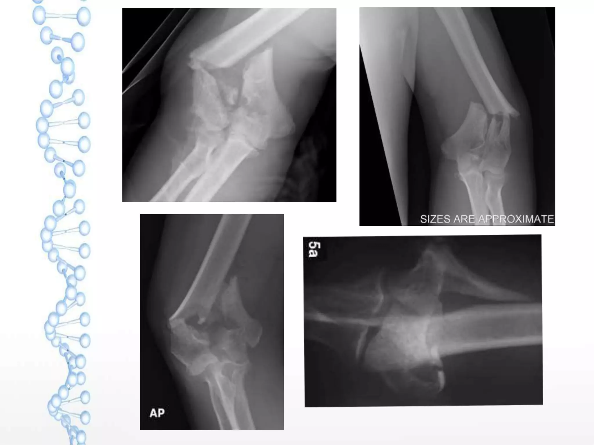 Distal humerus fracture and elbow dislocation by dr ashutosh | PPT