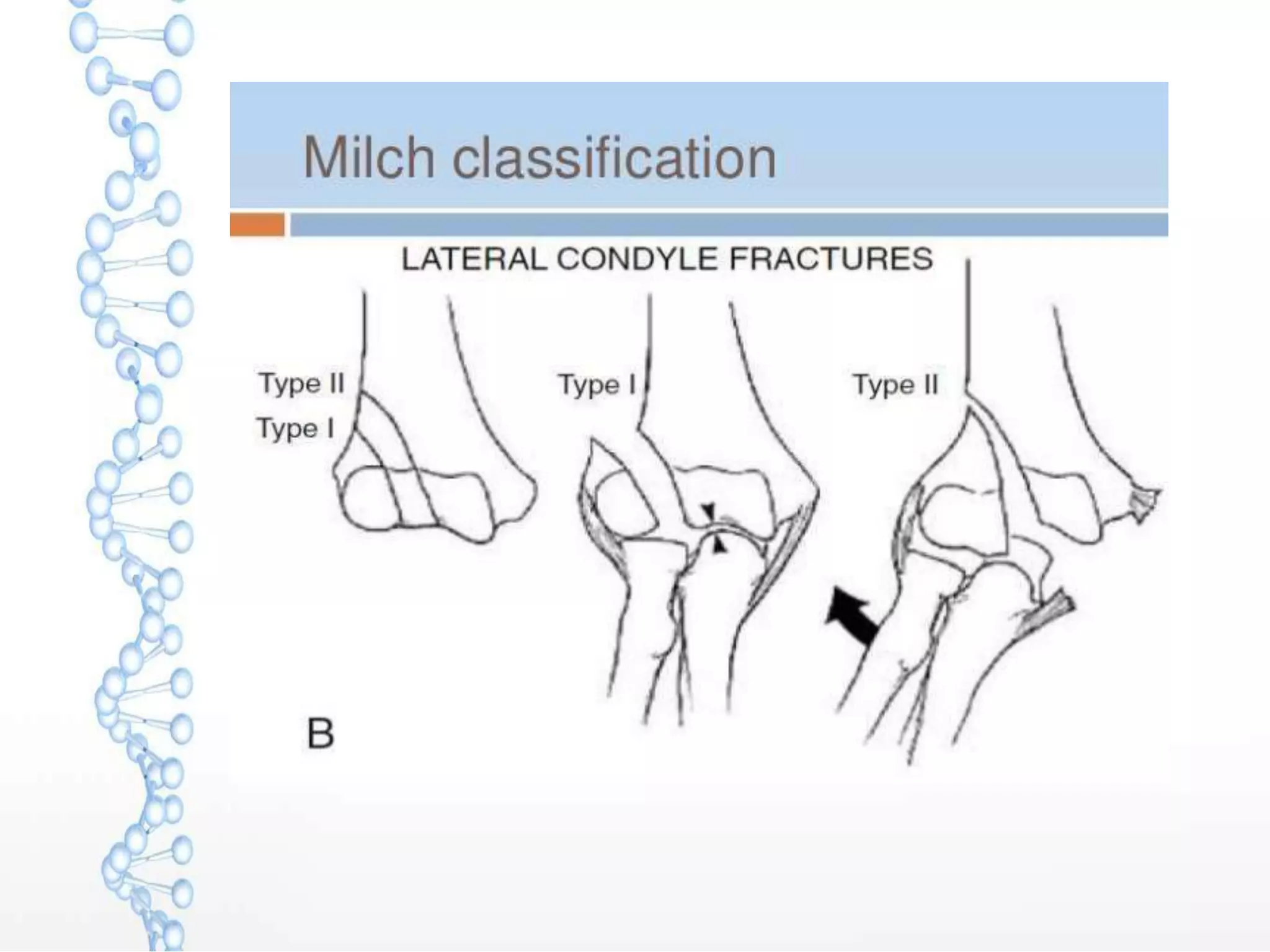 Distal humerus fracture and elbow dislocation by dr ashutosh | PPT