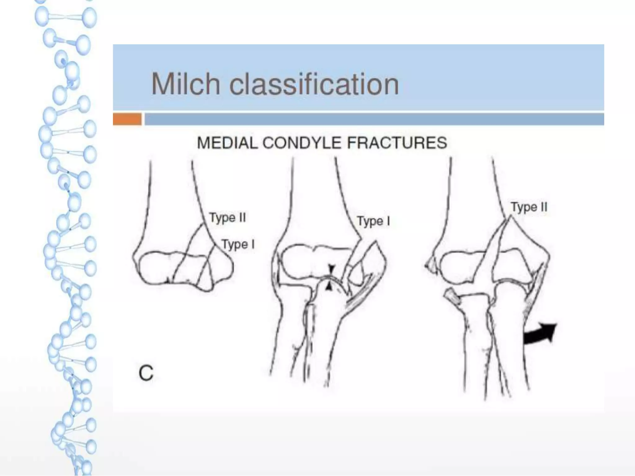 Distal humerus fracture and elbow dislocation by dr ashutosh | PPT
