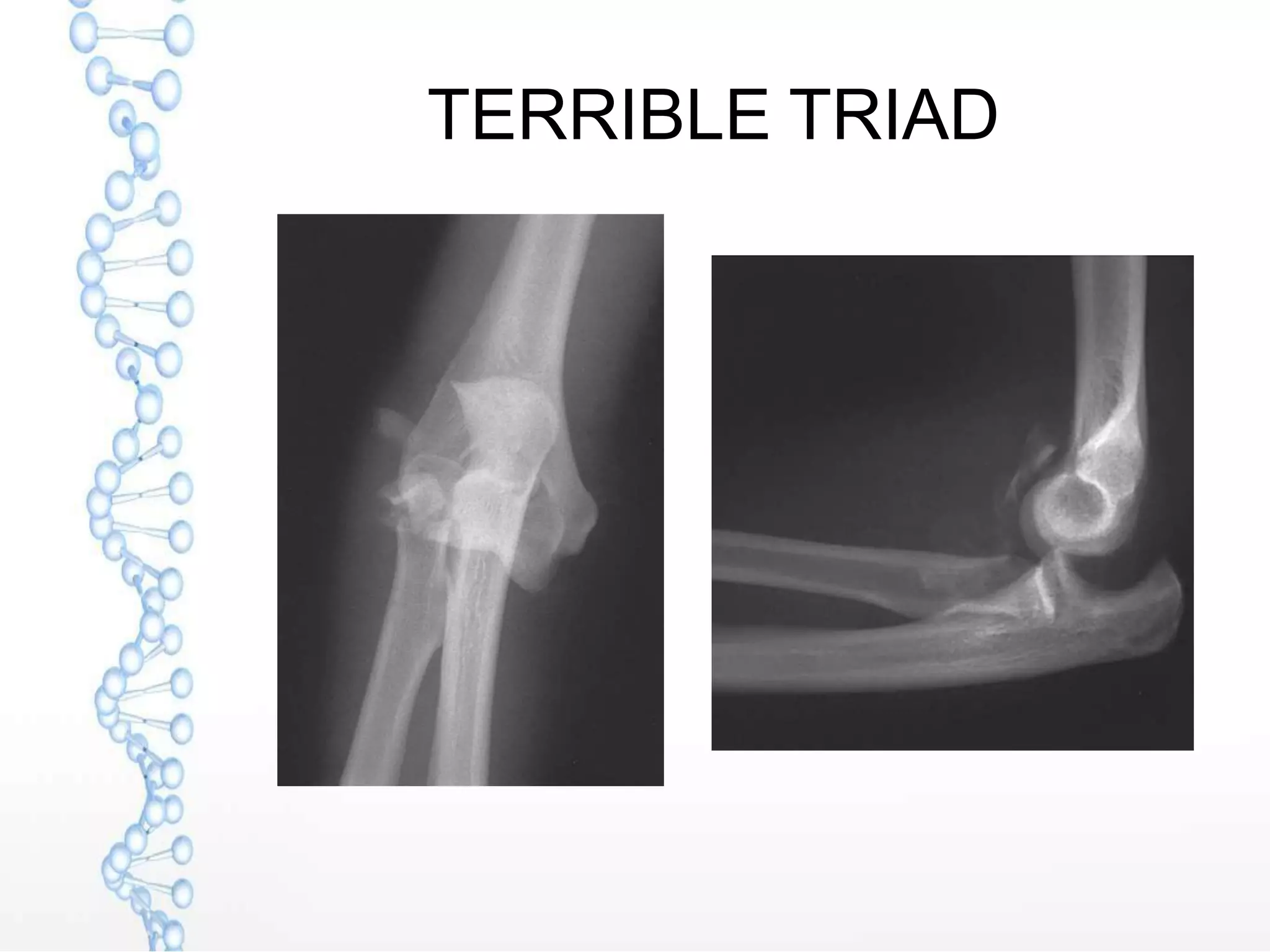 Distal humerus fracture and elbow dislocation by dr ashutosh | PPT