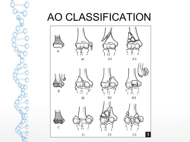 Distal humerus fracture and elbow dislocation by dr ashutosh | PPT