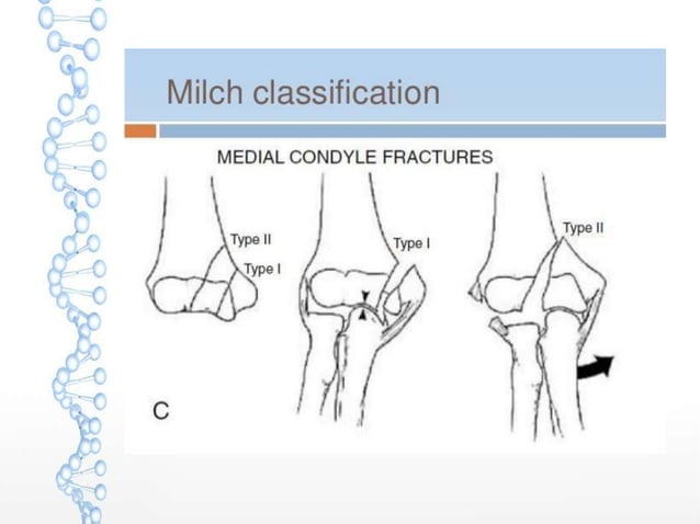 Distal humerus fracture and elbow dislocation by dr ashutosh | PPT
