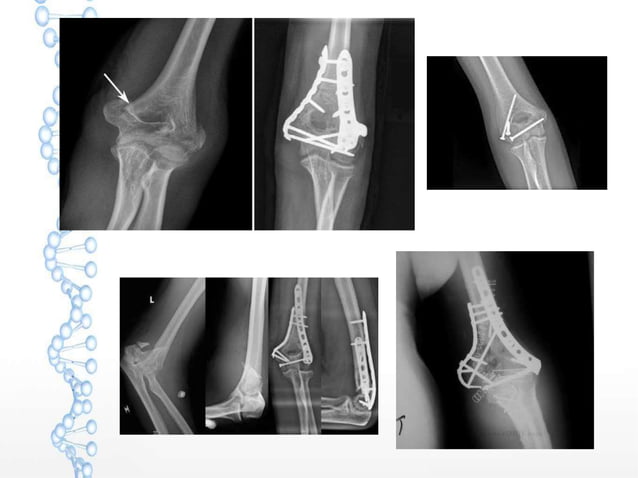 Distal humerus fracture and elbow dislocation by dr ashutosh | PPT