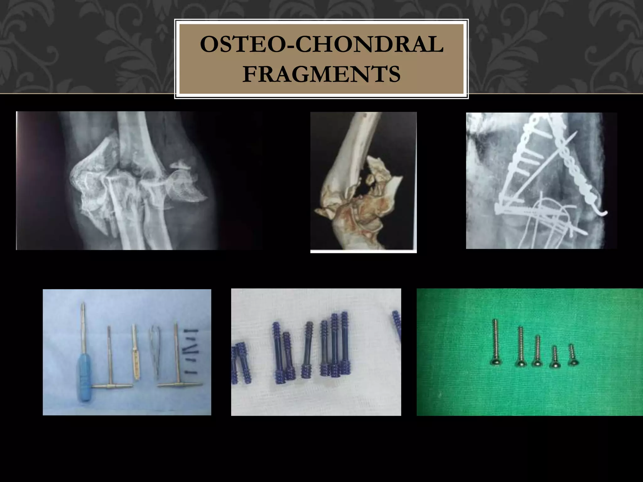 Distal humerus fracture fixation dr mohamed ashraf-HOD-govt TD medical ...