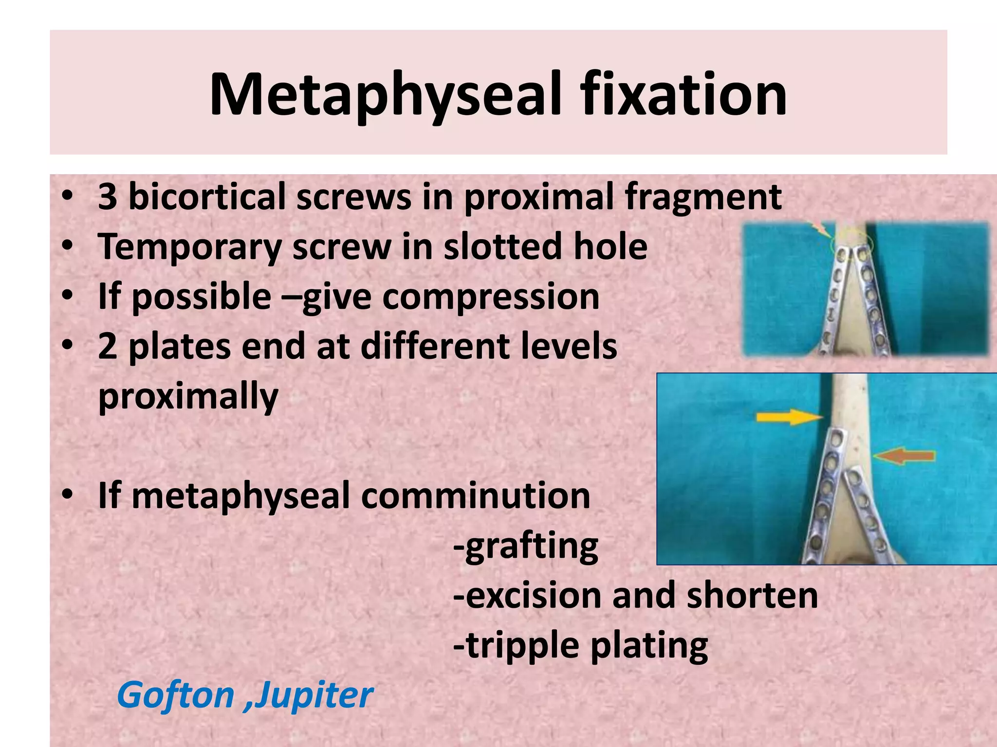 Distal humerus fracture fixation dr mohamed ashraf-HOD-govt TD medical ...