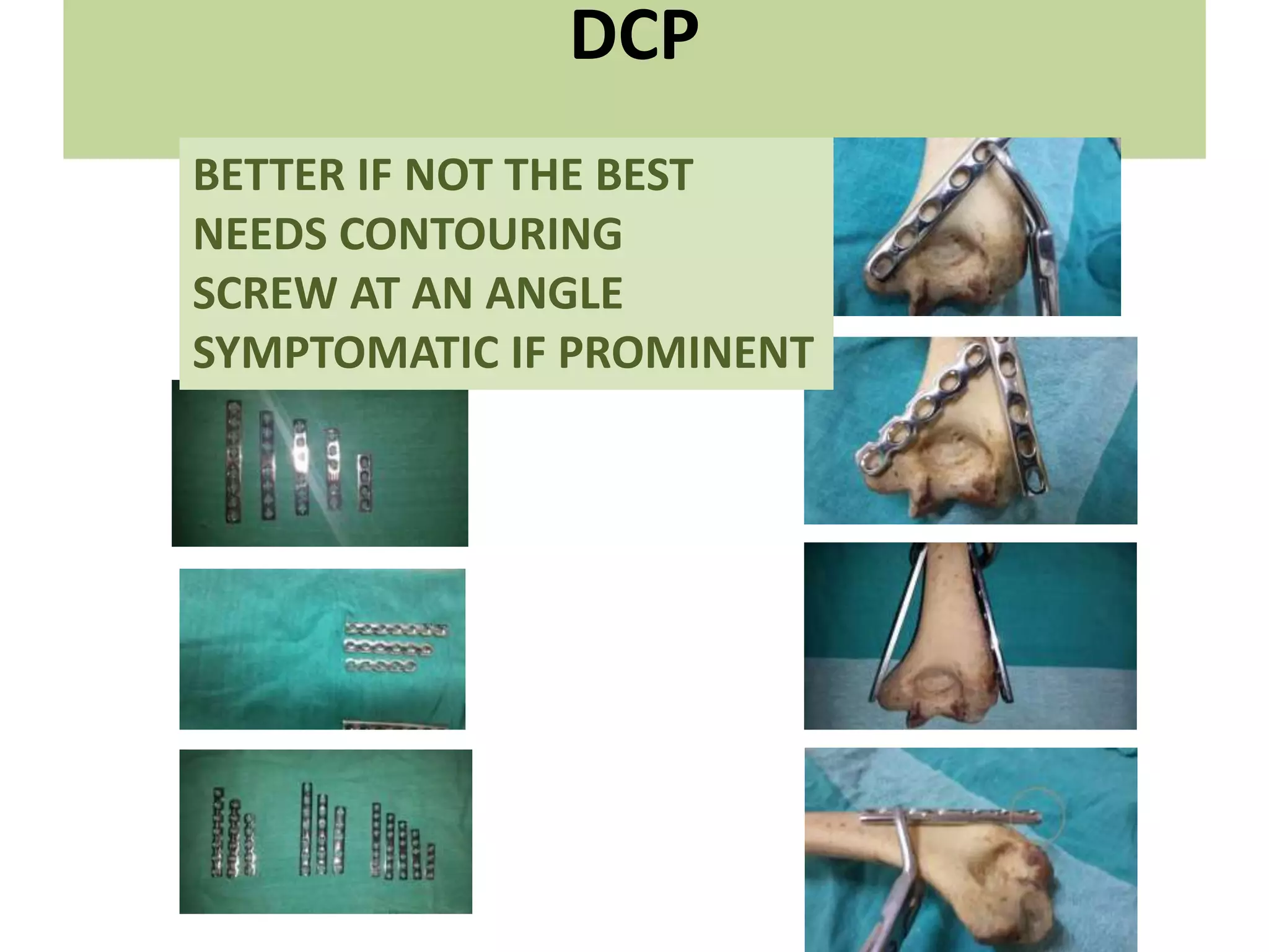 Distal humerus fracture fixation dr mohamed ashraf-HOD-govt TD medical ...