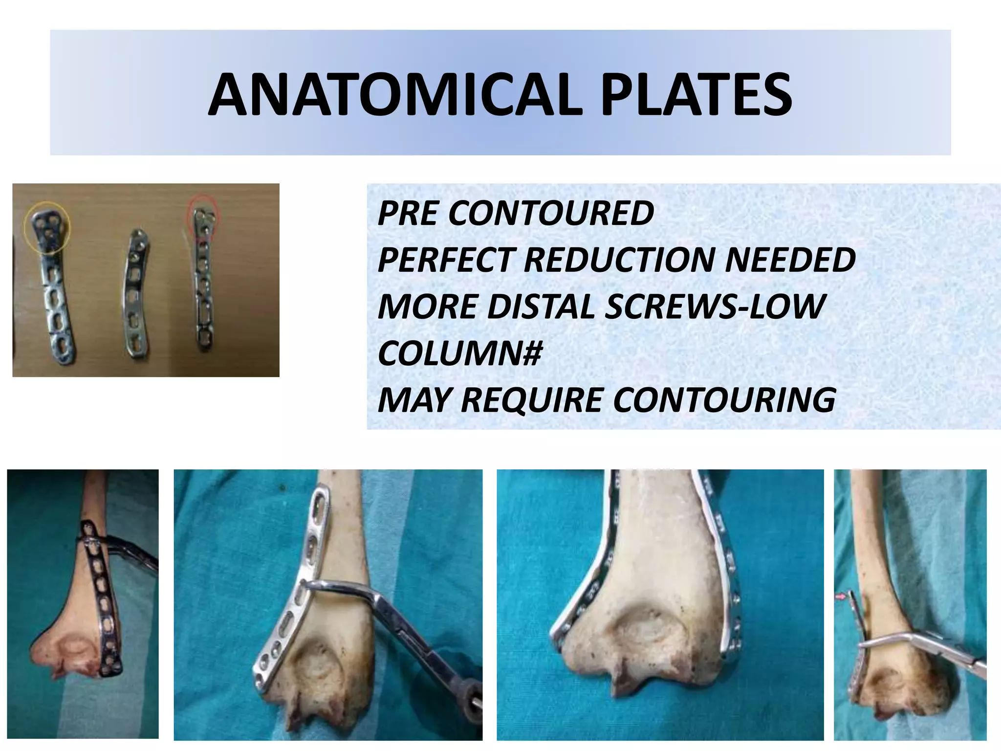 Distal humerus fracture fixation dr mohamed ashraf-HOD-govt TD medical ...