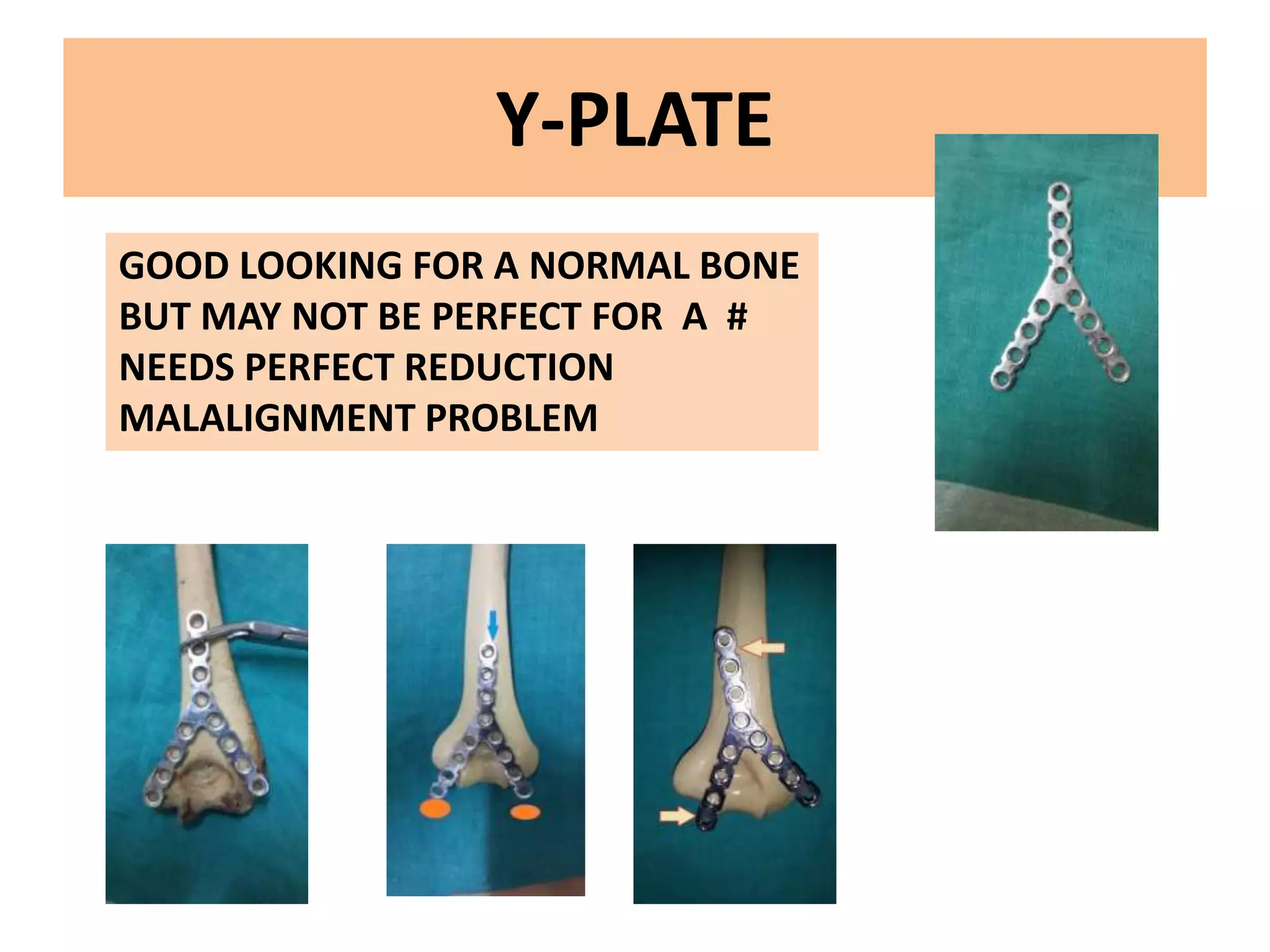 Distal humerus fracture fixation dr mohamed ashraf-HOD-govt TD medical ...