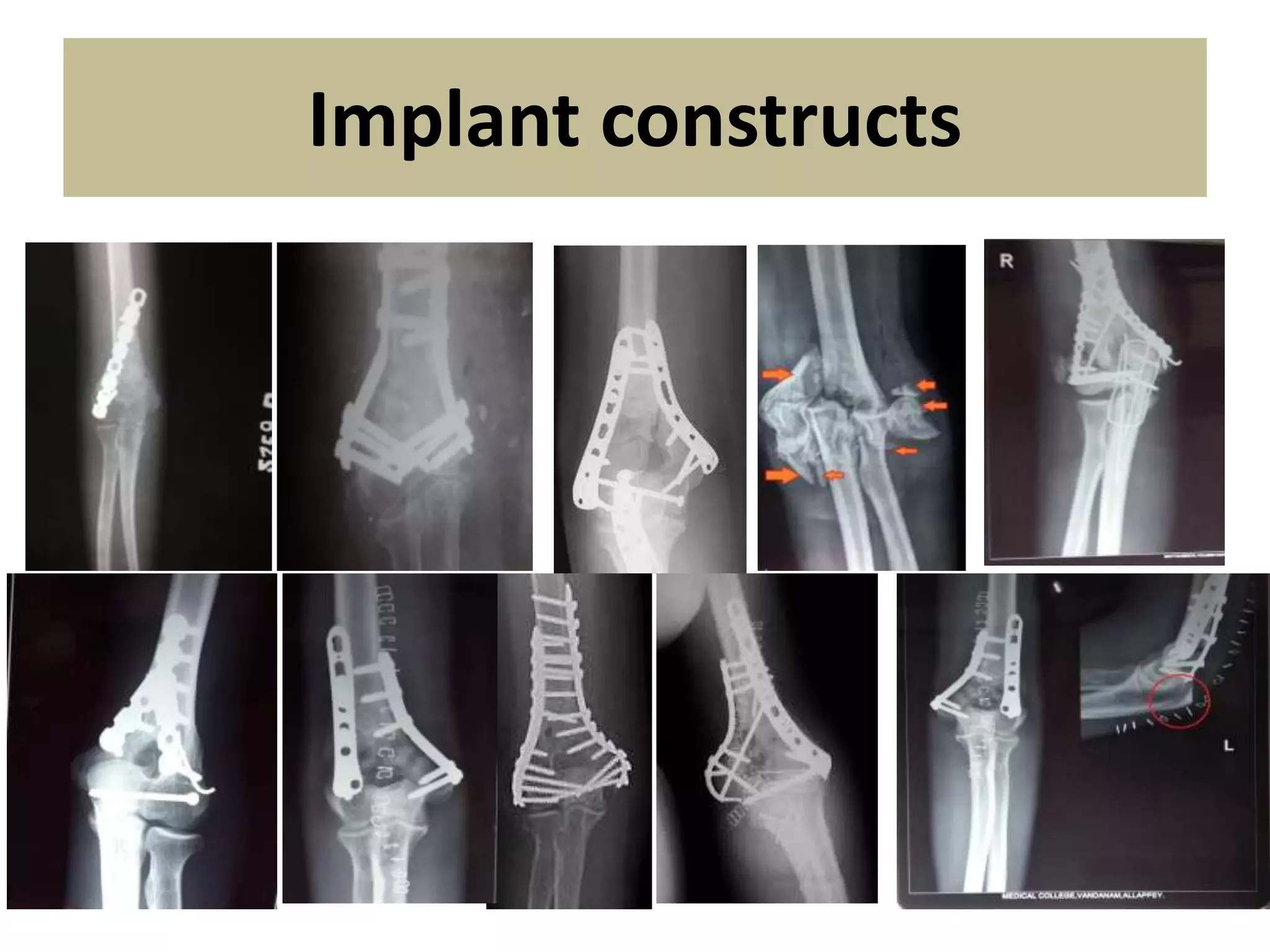 Distal humerus fracture fixation dr mohamed ashraf-HOD-govt TD medical ...