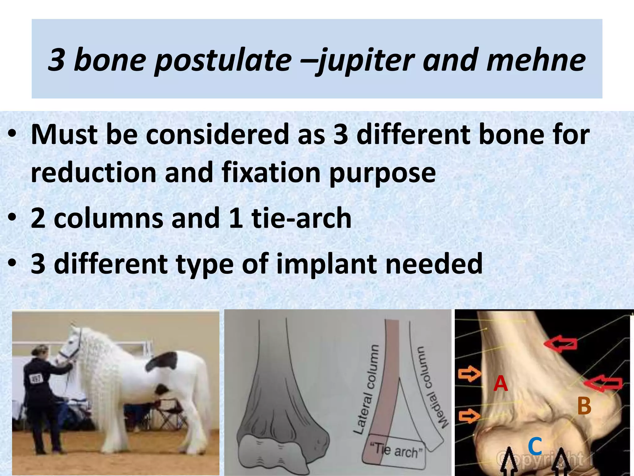Distal humerus fracture fixation dr mohamed ashraf-HOD-govt TD medical ...