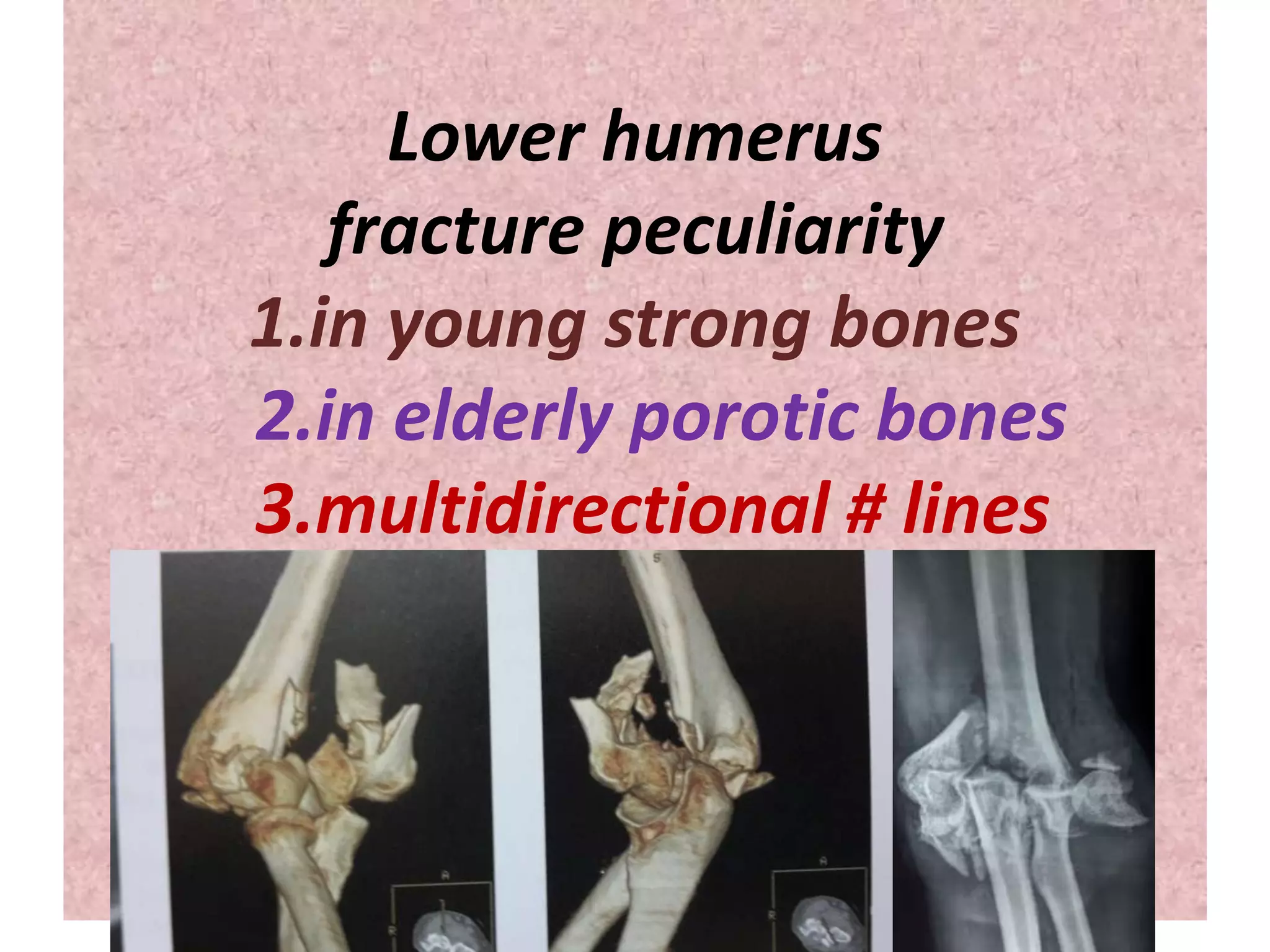 Distal humerus fracture fixation dr mohamed ashraf-HOD-govt TD medical ...