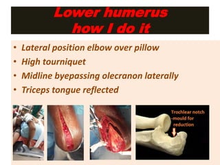 Distal humerus fracture fixation dr mohamed ashraf-HOD-govt TD medical ...