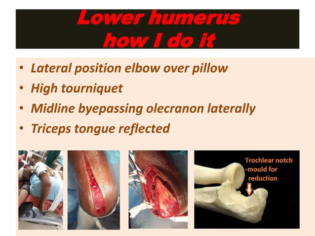 Distal humerus fracture fixation dr mohamed ashraf-HOD-govt TD medical ...