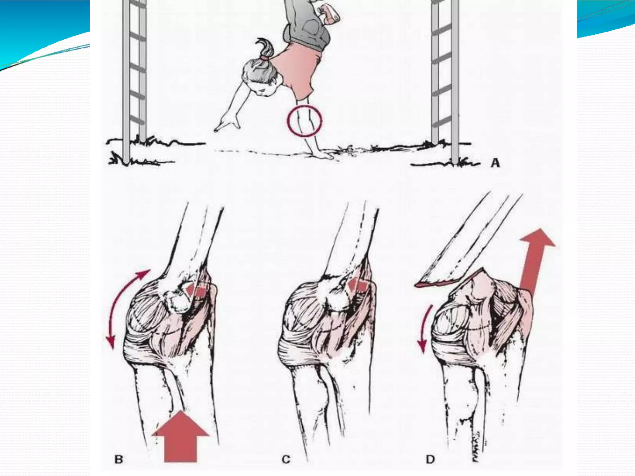 Distal humerus fracture in pediatrics by dr ashutosh | PPT
