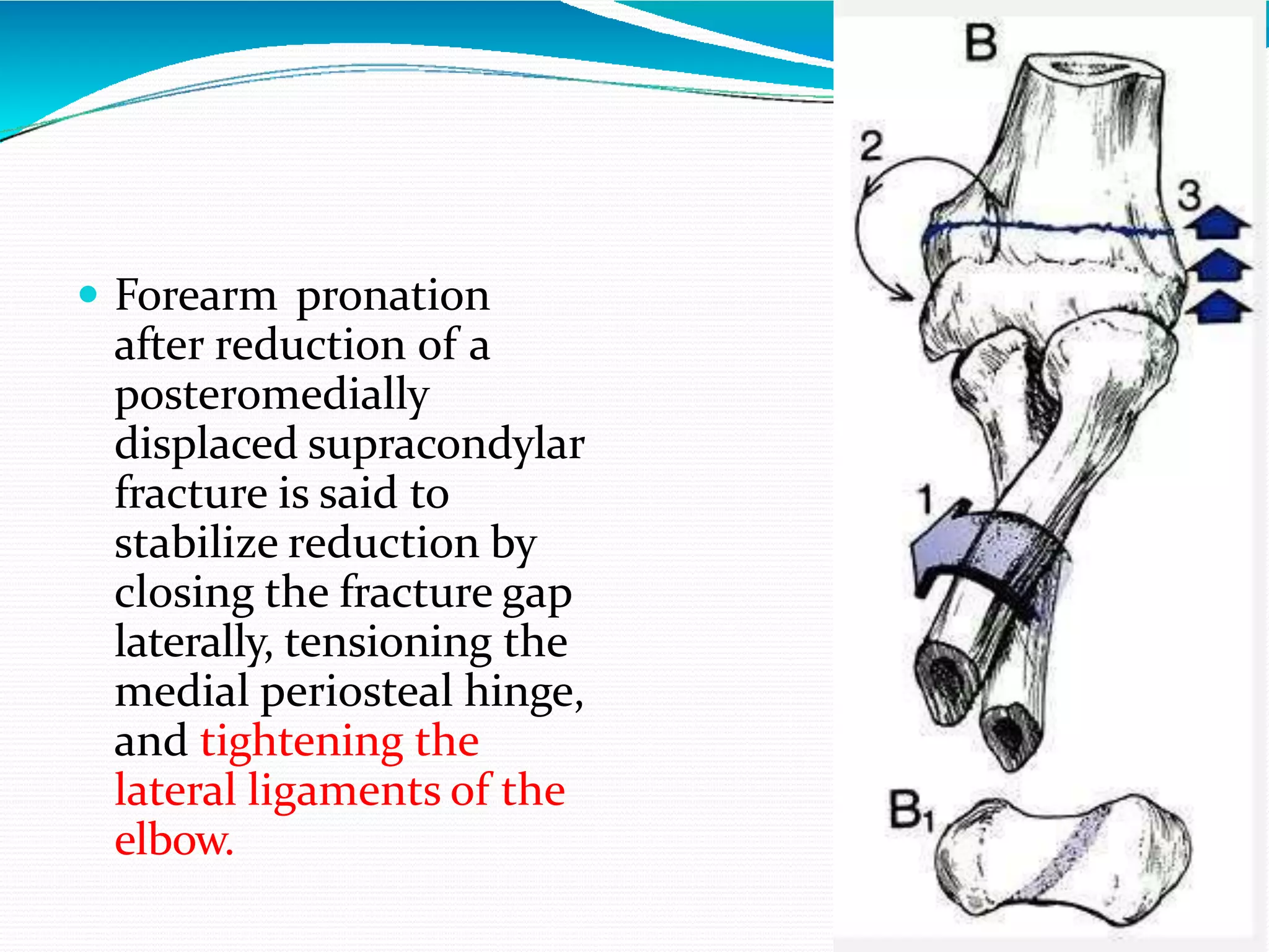 Distal humerus fracture in pediatrics by dr ashutosh | PPT
