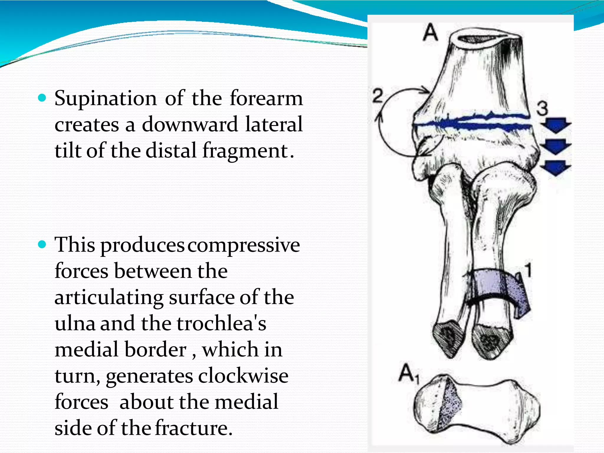 Distal humerus fracture in pediatrics by dr ashutosh | PPT