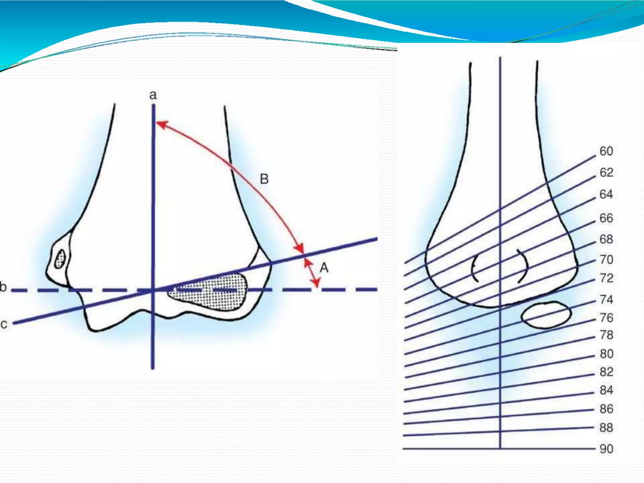 Distal humerus fracture in pediatrics by dr ashutosh | PPT