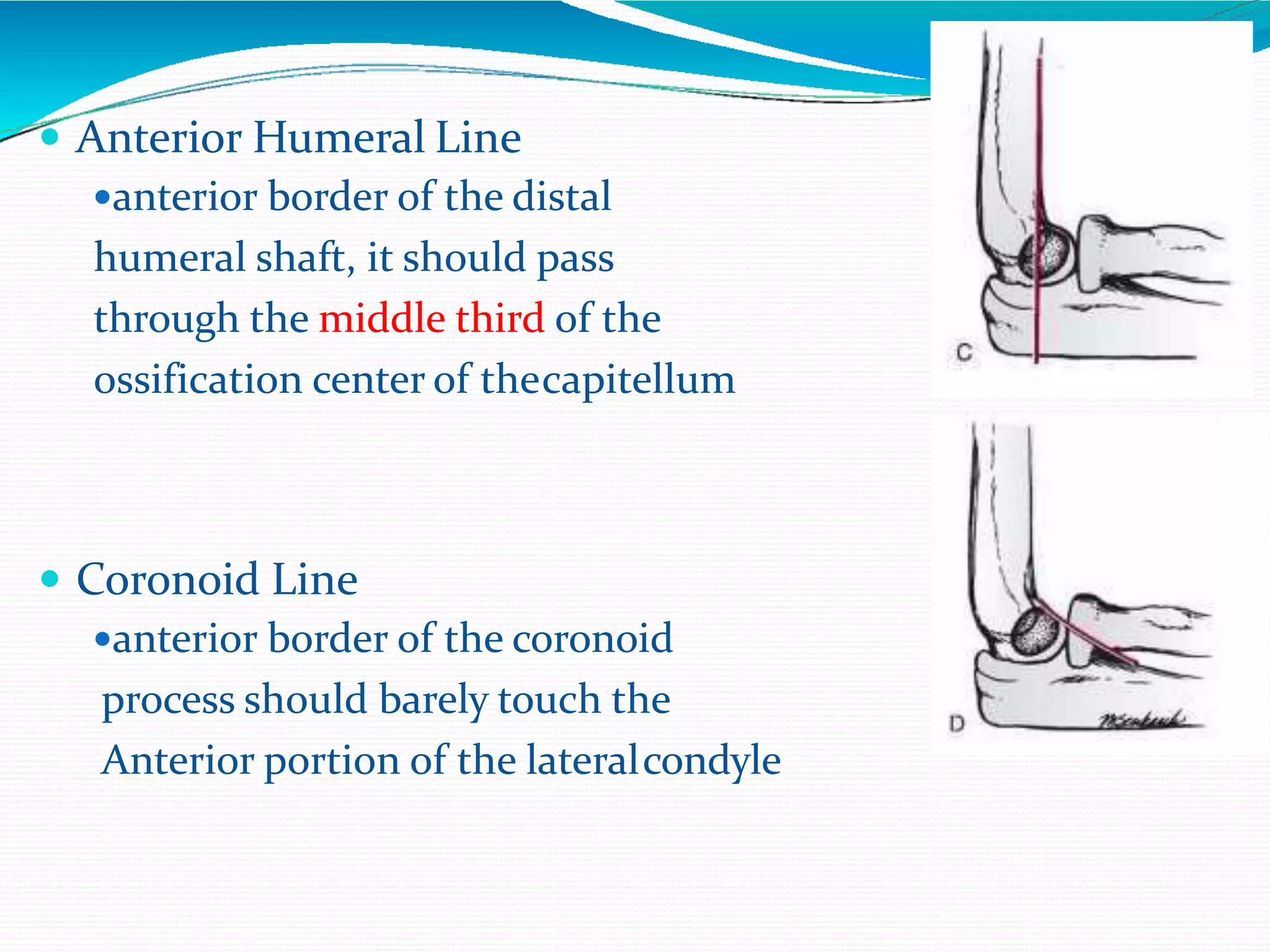Distal humerus fracture in pediatrics by dr ashutosh | PPT